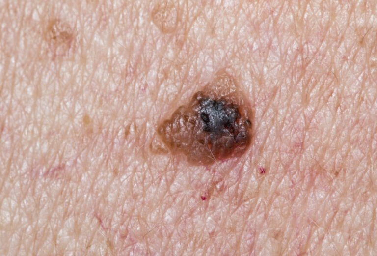 Don’t Ignore These Warning Signs: Learn to Spot Skin Cancer