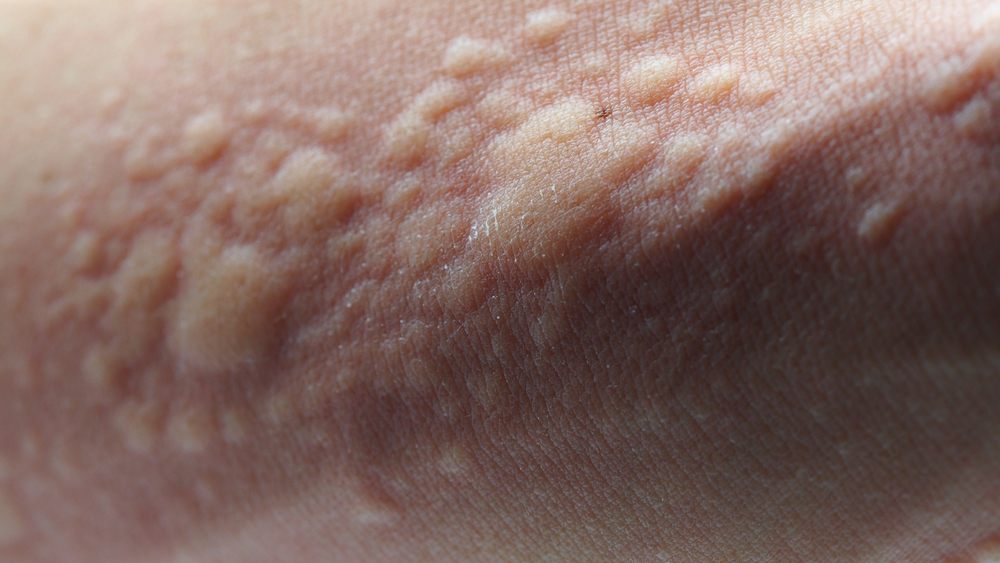 How to Relieve Itching From Nettle Stings