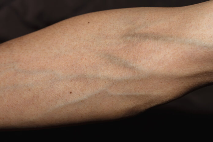 Do You Have Light Blue Veins on Your Hands? Here’s What You Need to Know