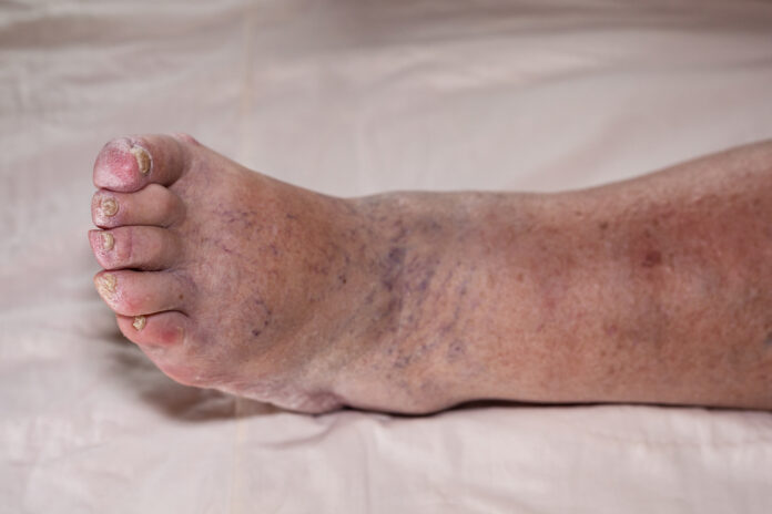 This Is Why Your Legs Are Swelling — And What You Can Do About It